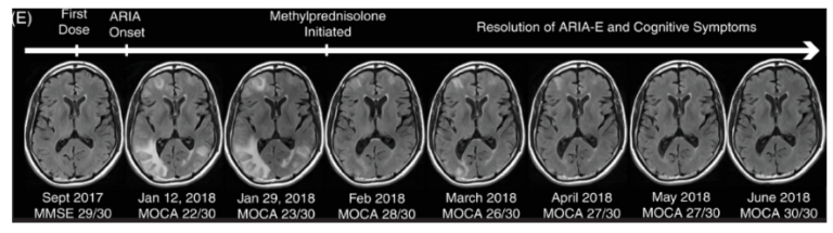 Amyloid Related Imaging Abnormalities (ARIA) – Medicin.wiki Amyloid Related Imaging Abnormalities (ARIA) – Medicin.wiki